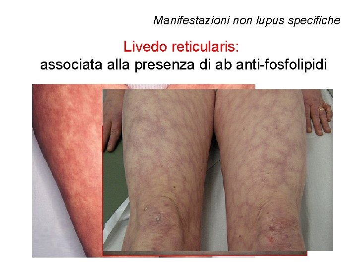 Connettiviti Lupus Eritematoso Sistemico Sindrome Da Anticorpi