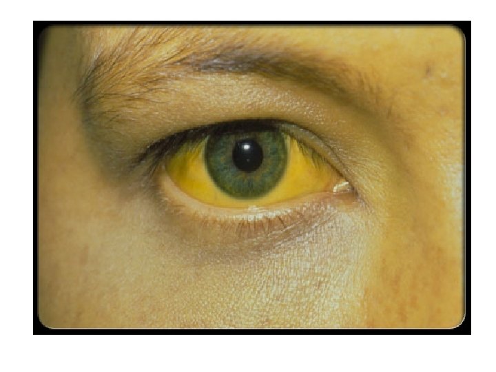 Viral Hepatitis Objectives 1 to know the method