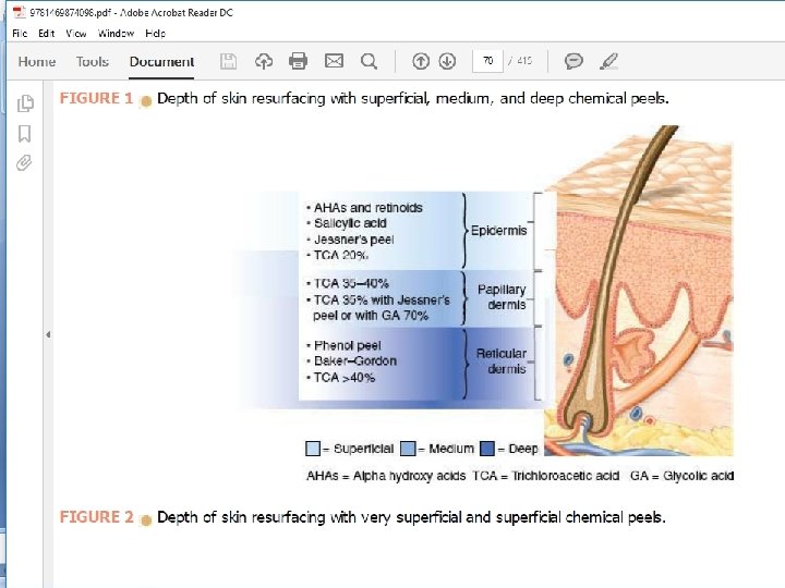 Chemical Peeling Introduction remove the outer layers of