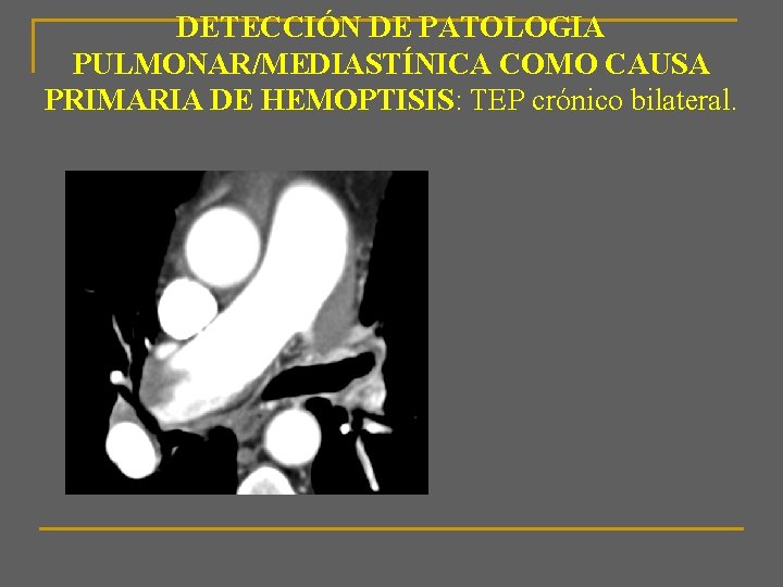 DETECCIN DE PATOLOGIA PULMONARMEDIASTNICA COMO CAUSA PRIMARIA DE