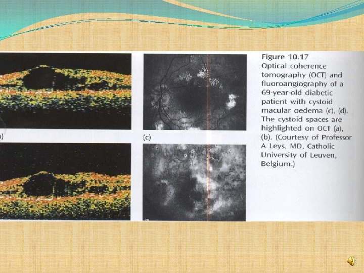 Surgical treatment for Diabetic Retinopathy Vitrectomy is indicated
