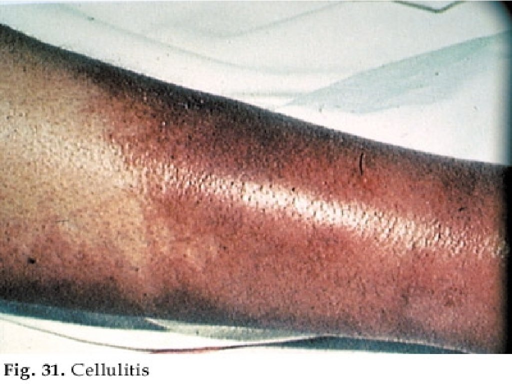 INFECCIONES DE PIEL Y TEJIDOS BLANDOS JULIO CESAR