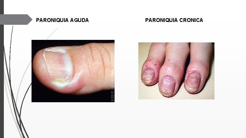 INFECCIONES BACTERIANAS DE LA PIEL Y TEJIDOS SUBCUTANEOS