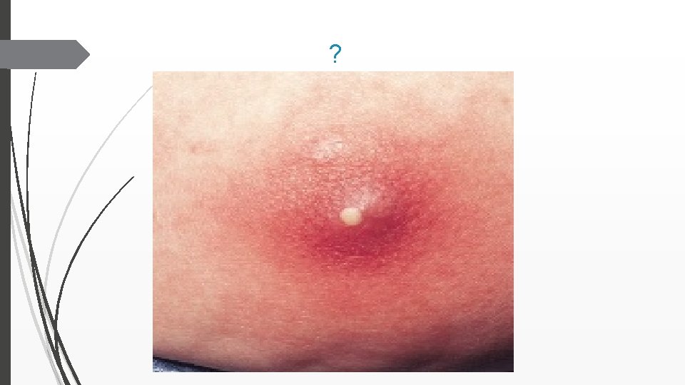 INFECCIONES BACTERIANAS DE LA PIEL Y TEJIDOS SUBCUTANEOS