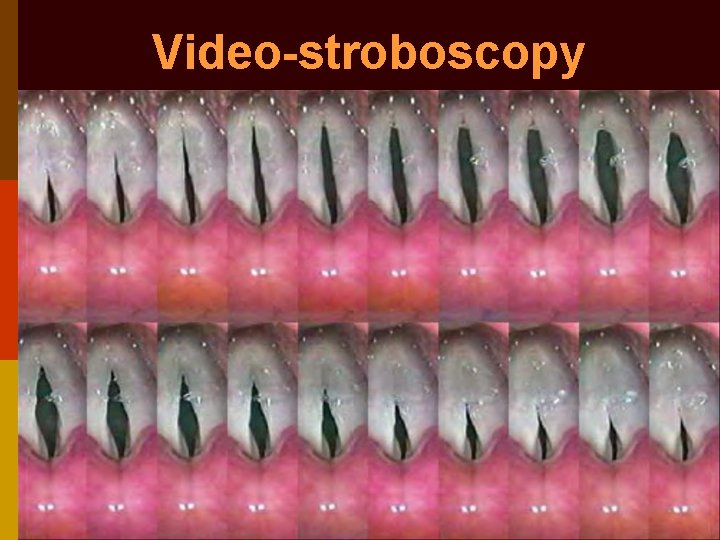 Vocal cord palsy evaluation of hoarseness Dr Vishal