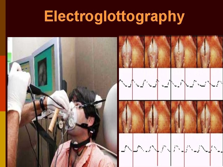 Vocal cord palsy evaluation of hoarseness Dr Vishal