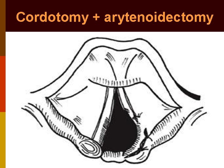 Vocal cord palsy evaluation of hoarseness Dr Vishal