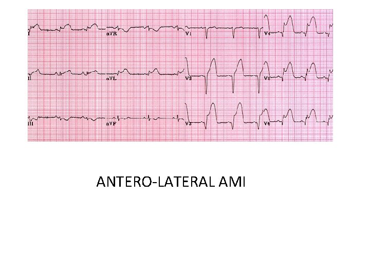 INFARKTI AKUT I MIOKARDIT Dr Sidita Vitoja IAM