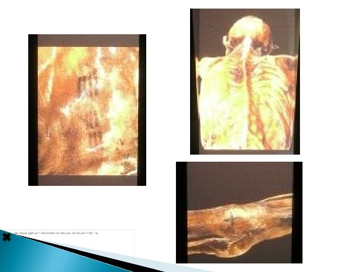 The Iceman Otzi Introduction Otzi is a wellpreserved
