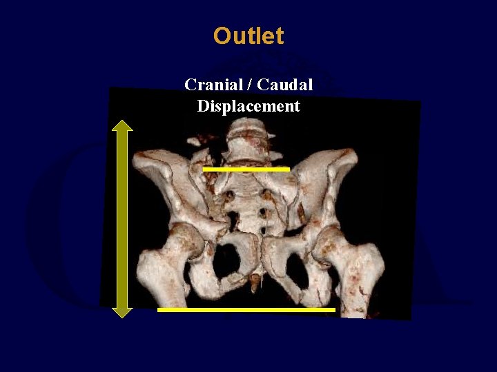 Radiographic Evaluation and Classification of Pelvic Ring Disruptions
