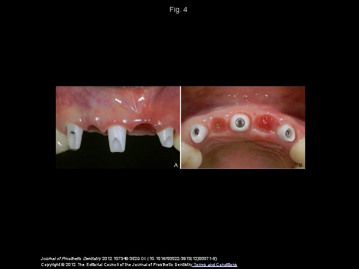 Modified root submergence technique for multiple implantsupported maxillary