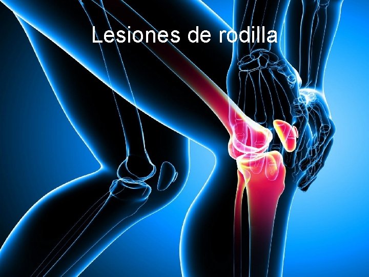 Lesiones de rodilla La rodilla est compuesta por