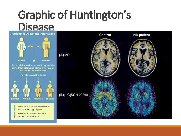 Huntingtons Disease BY SAM DAVIS SABRINA TRAN MYA