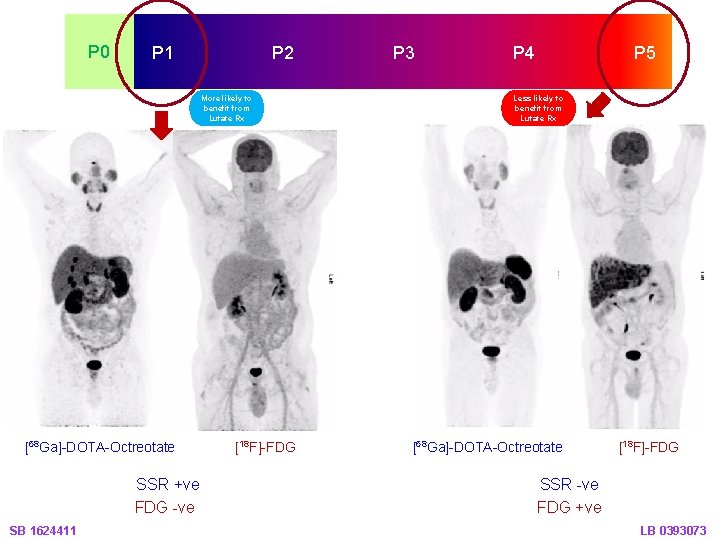 A GRADING SCHEME FOR COMBINED SOMATOSTATIN RECEPTOR SSR
