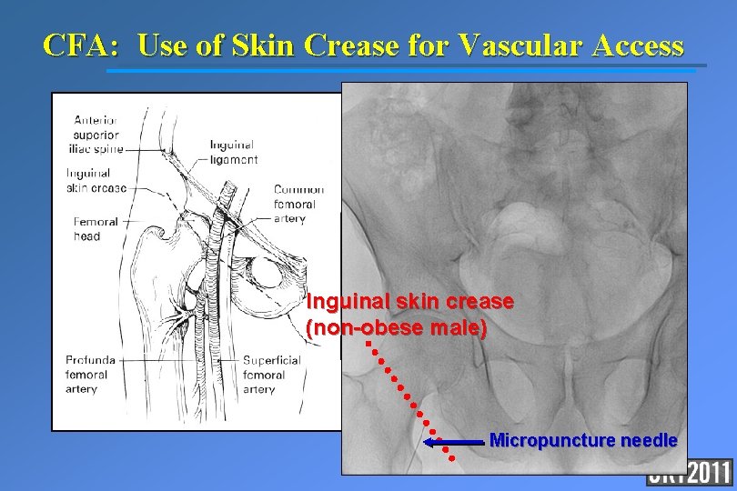 Transcatheter Valves for the Surgeon February 27 2011