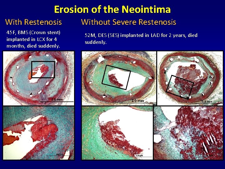 New Pathology Insights for the Vulnerable Plaque Neoatherosclerosis