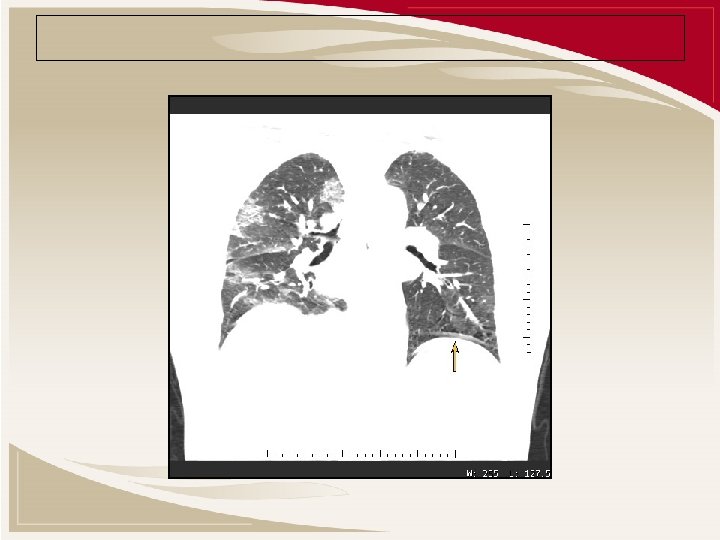 PEMERIKSAAN CT SCAN THORAX PADA PASIEN DENGAN COVID