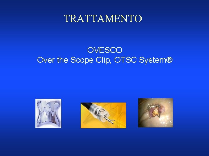 EROSIONE INTRALUMINALE BANDING Bendaggio Gastrico Regolabile Migrazione ...