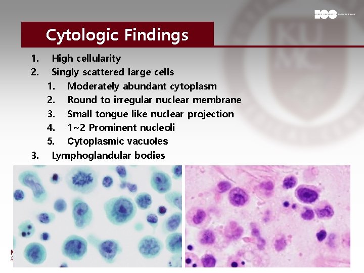 2012 04 Diagnosis Pleural fluid left aspiration cytology