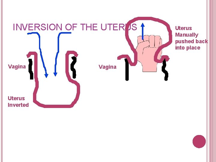 Complications of Post Partum POSTPARTUM HEMORRHAGE Early Occurs