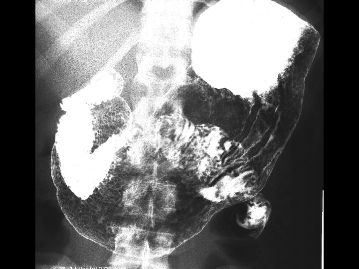 PA XR Plain Film Lateral XR Plain Film