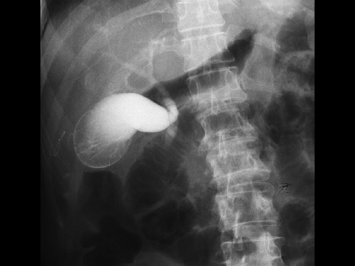 PA XR Plain Film Lateral XR Plain Film