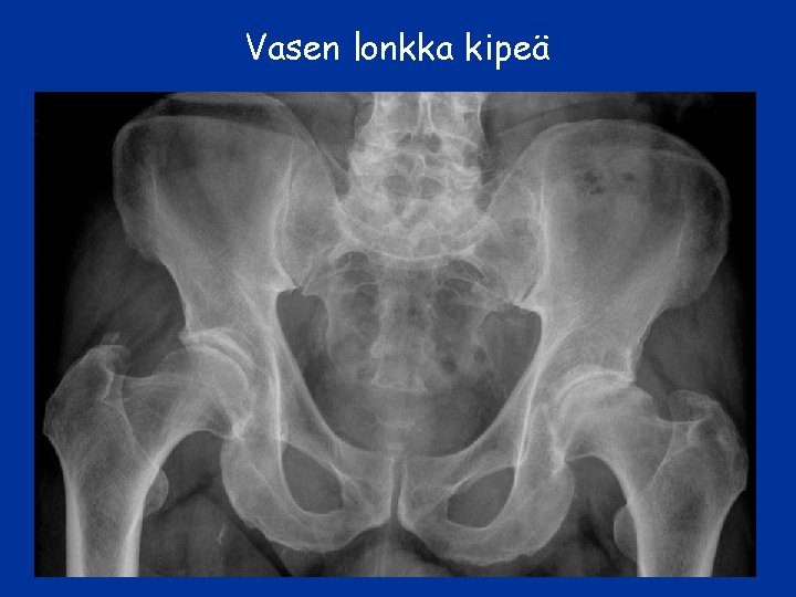 Eitraumaattisten luun ja nivelten sairauksien radiologinen ...