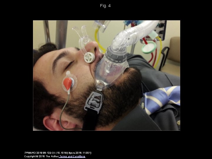 High frequency percussive ventilation for respiratory immobilization in