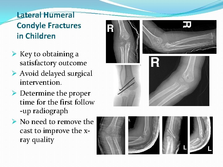 Lateral Humeral Condyle Fractures in Children The Potential