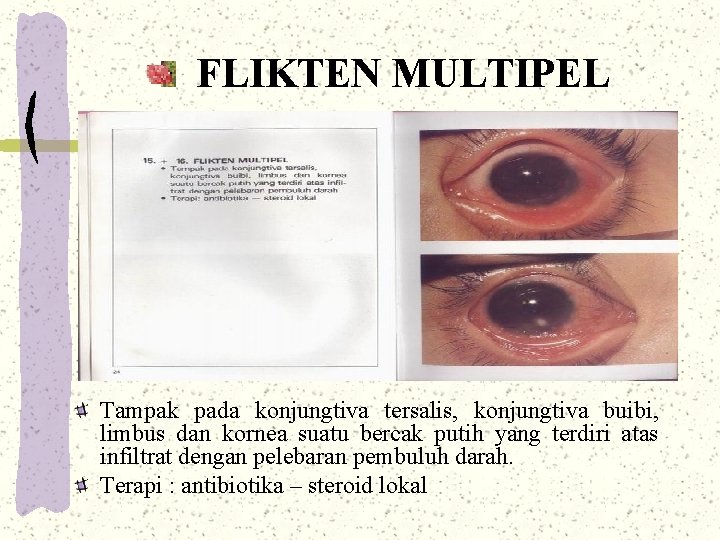 Penyakit Mata Kerja FLIKTEN MULTIPEL Tampak pada konjungtiva