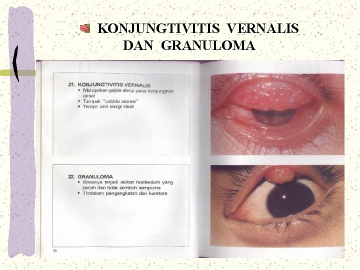 Penyakit Mata Kerja FLIKTEN MULTIPEL Tampak pada konjungtiva