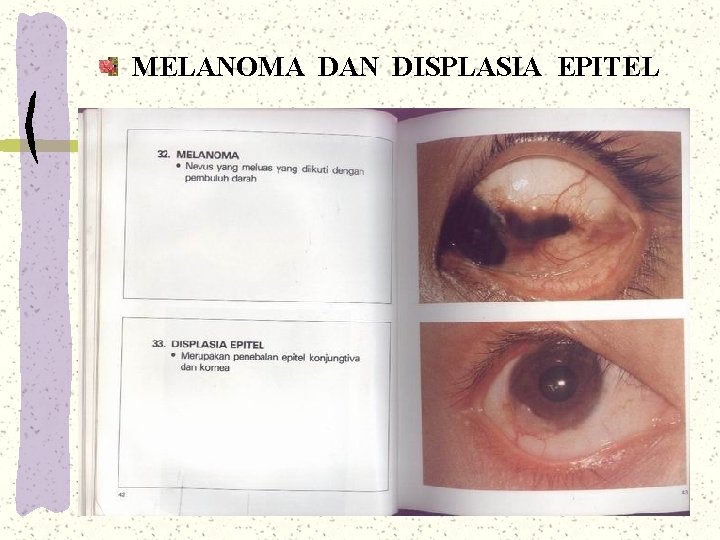 Penyakit Mata Kerja FLIKTEN MULTIPEL Tampak pada konjungtiva