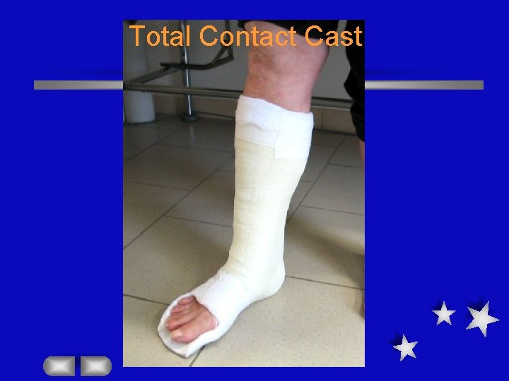 PIED DE CHARCOT Subluxations luxations et puis fractures