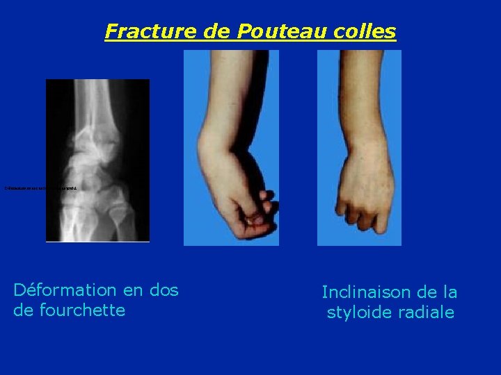 Fractures de lavantbras La pronosupination Pronation intermdiaire ...
