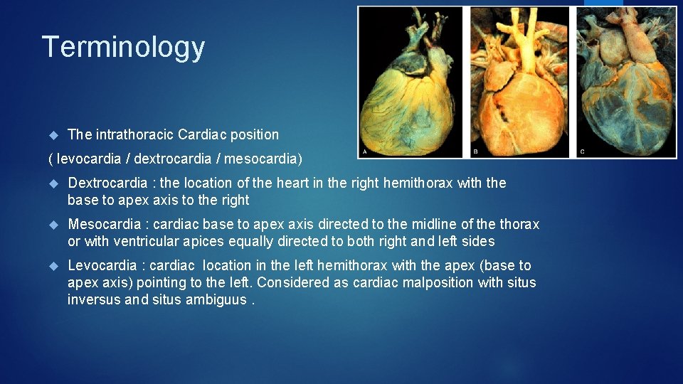 Cardiac Malpositions PRESENTER DR ANISH Cardiac Malpositions Terminology