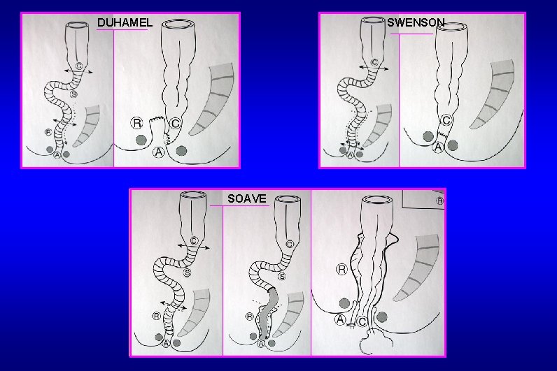 Occlusions nonatales Pr F Varlet Introduction Urgences nonatales