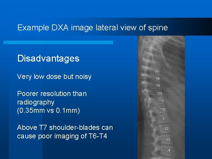 Vertebral shape automatic measurement by DXA using overlapping