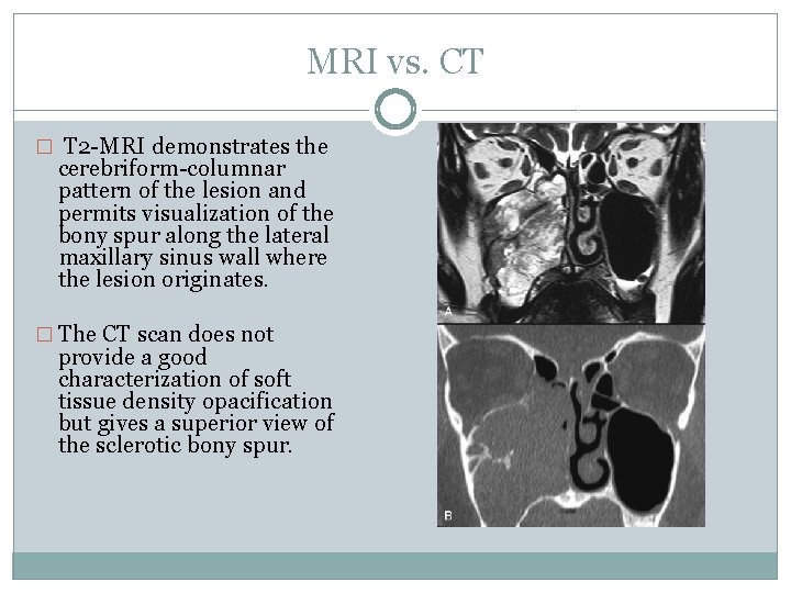 Chapter 48 FUNGAL RHINOSINUSITIS Fungal Rhinosinusitis Acute invasive