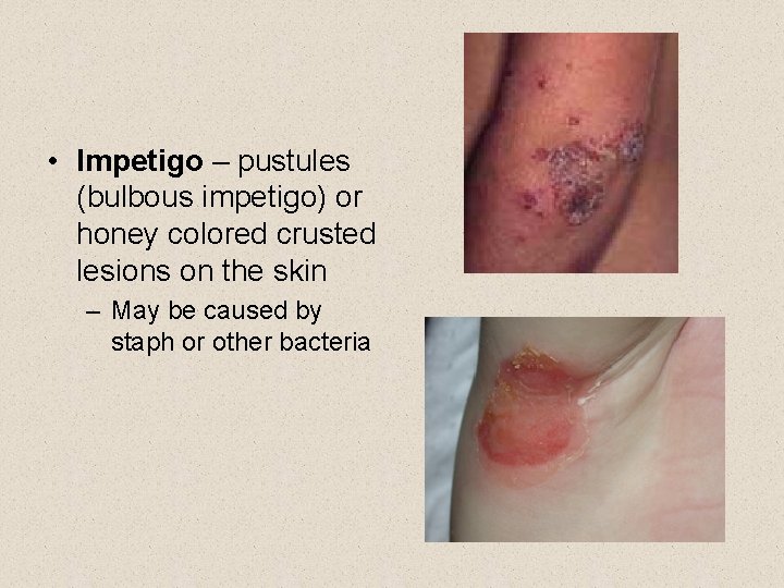 Staph Infections including MRSA What is a Staph