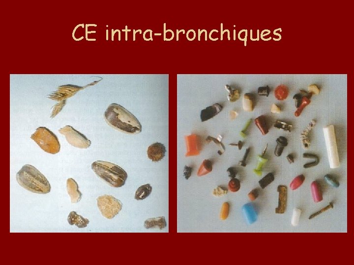 A ajouter au cours Mastoidite Ethmoidite Ligature ethmoidale
