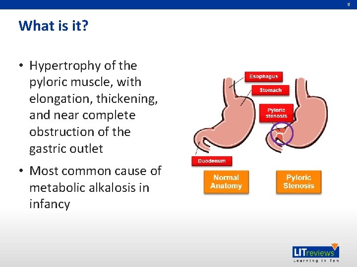 Pyloric Stenosis Authors Elizabeth Strachan MD Level Basic