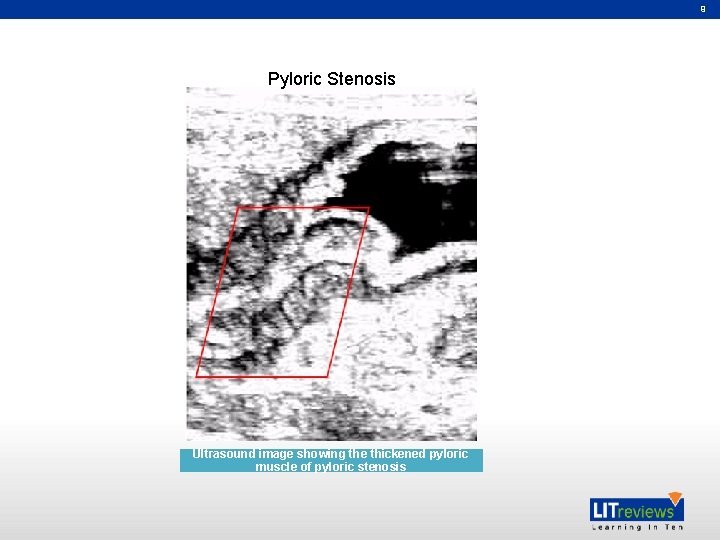 Pyloric Stenosis Authors Elizabeth Strachan MD Level Basic