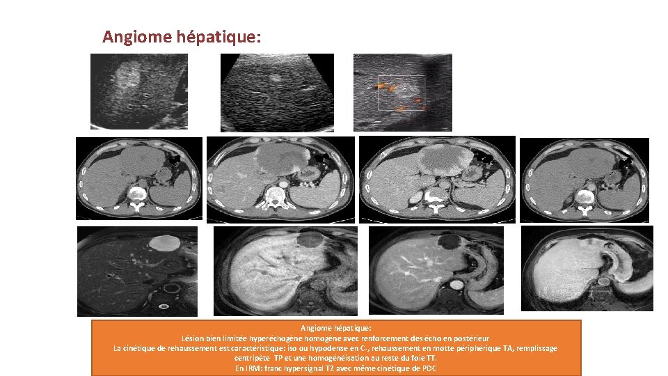 CONDUITE A TENIR DEVANT UNE MASSE HEPATIQUE POUR