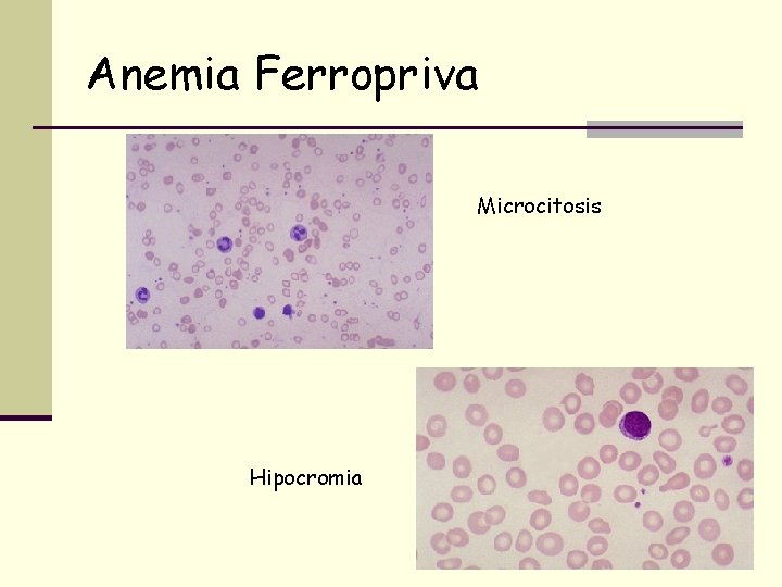 Anemia Ferropriva Fecha de publicacin 020308 Dr Hugo