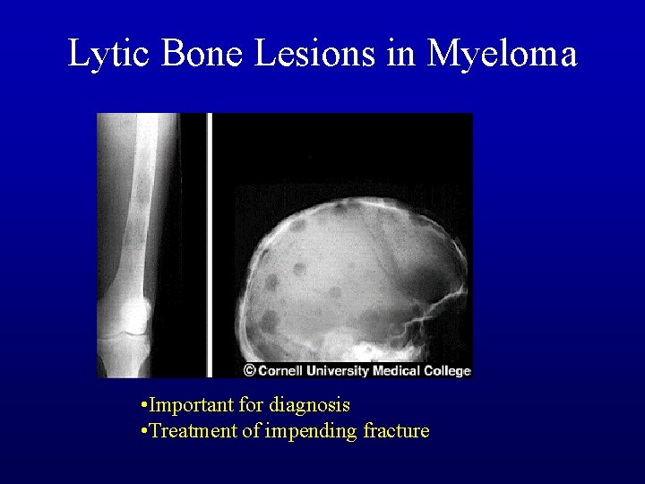 Diagnosis and Treatment of Multiple Myeloma Mark B