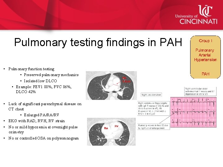 Pulmonary Hypertension What you need to know for