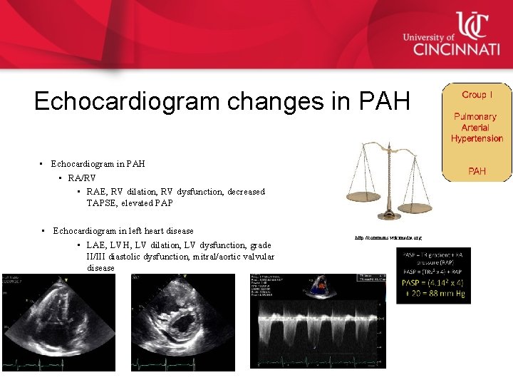 Pulmonary Hypertension What you need to know for