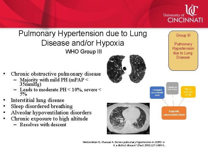 Pulmonary Hypertension What you need to know for