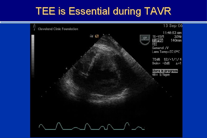 TEE is Essential During TAVR E Murat Tuzcu