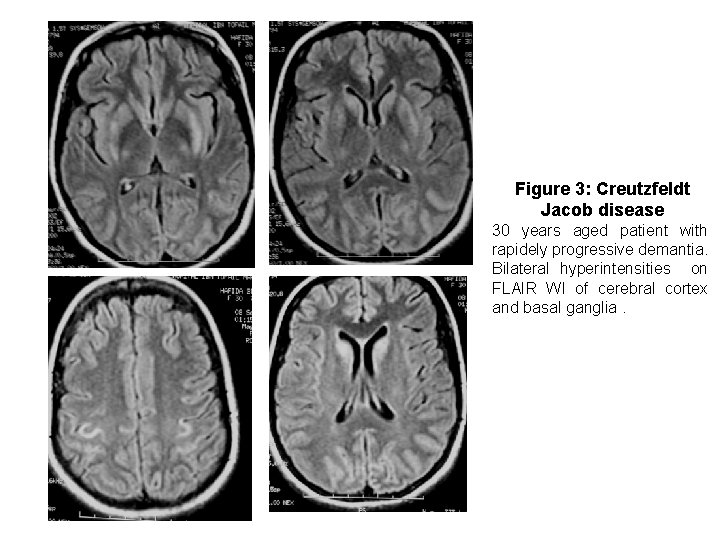 Abnormalities of the basal ganglia and thalami S